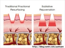 Sublative Rejuvenation (매트릭스 RF) : 네이버 블로그