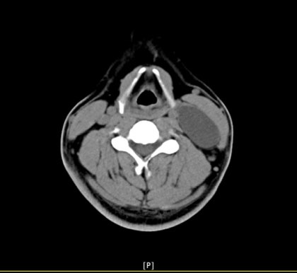 intraglandular cleft