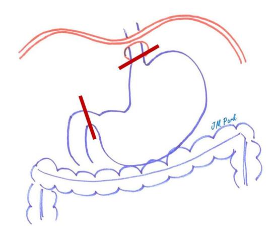 Total Gastrectomy With Roux En Y Esophagojejunostomy