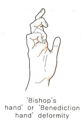 Bishops Hand Deformity