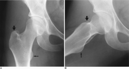 frog leg view position