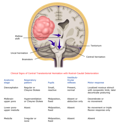 Transtentorial Herniation