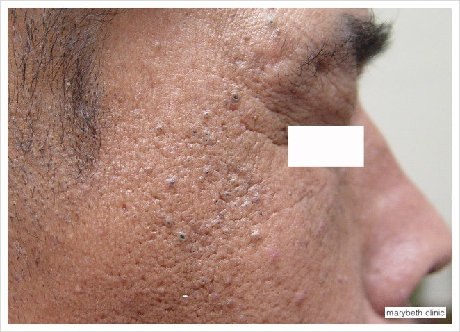 16. 노인성 면포(Senile Comedones) - 여드름과 닮은 질환 : 네이버 블로그