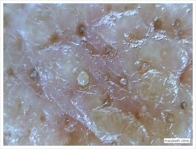 16. 노인성 면포(Senile Comedones) - 여드름과 닮은 질환 : 네이버 블로그