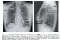 Normal PA & Lateral CXR : 네이버 블로그