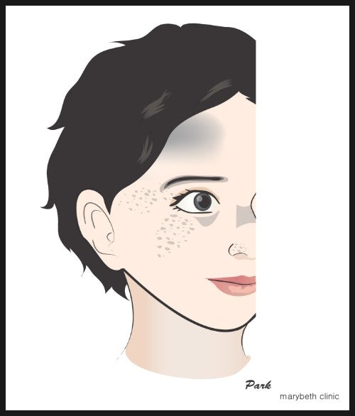 후천양측오타모반모양반(Acquired bilateral nevus of Ota-like macules, ABNOM)의 임상 소견 ...