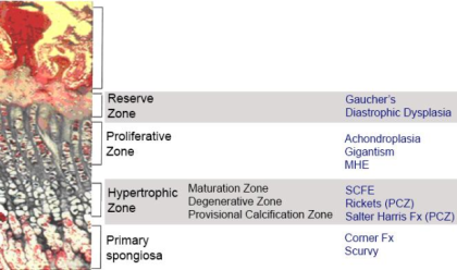 Diastrophic Dysplasia Bones