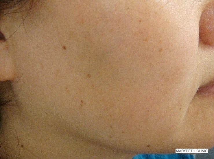 a. 단순흑자(Lentigo simplex) - 3. 흑자(흑색점) - A. 흑자 임상요약 - CO₂레이저(Carbon ...