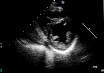 LCX territory infarction : 네이버 블로그