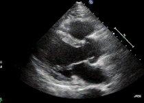 LCX territory infarction : 네이버 블로그