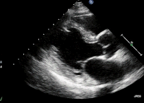 proximal LAD infarction : 네이버 블로그