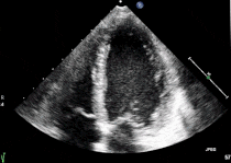LCX territory infarction : 네이버 블로그