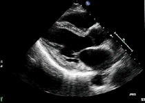 LCX territory infarction : 네이버 블로그