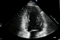 proximal LAD lesion : 네이버 블로그