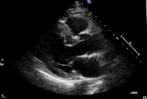 proximal LAD lesion : 네이버 블로그