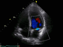 Systolic anterior motion(SAM) : 네이버 블로그