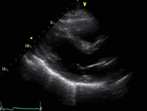 Systolic anterior motion(SAM) : 네이버 블로그
