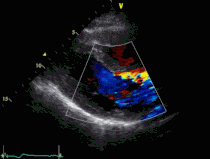 Systolic anterior motion(SAM) : 네이버 블로그