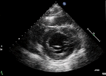 Inferior wall infarction : 네이버 블로그