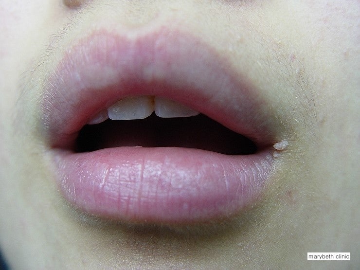 실모양사마귀(사상사마귀, Filiform wart) 또는 손가락모양사마귀(Digitate wart) : 네이버 블로그