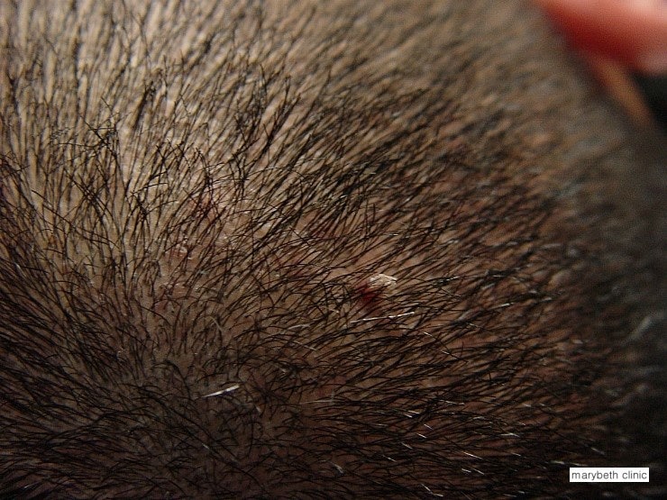 실모양사마귀(사상사마귀, Filiform wart) 또는 손가락모양사마귀(Digitate wart) : 네이버 블로그