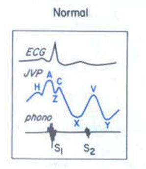 Abnormal Cvp Waveform