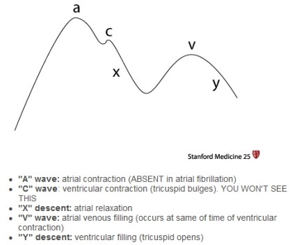 Deep Y-Descent In Right Atrial Waveforms Following Left, 40% OFF
