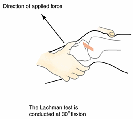 라크만 검사 _ Lachman's test(Special test) : 네이버 블로그
