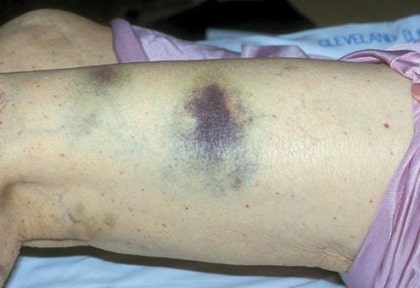 Immune Thrombocytopenic Purpura - Causes, Diagnoses, Treatment Dr ...