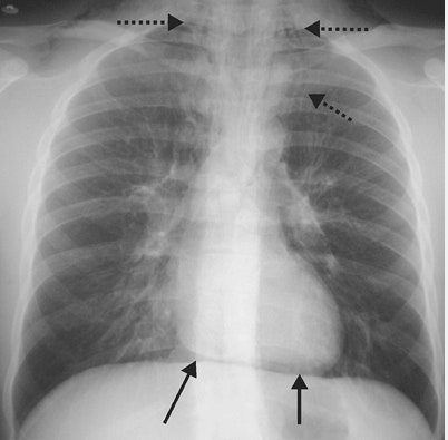 Continuous Diaphragm Sign