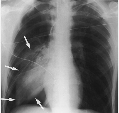 Continuous Diaphragm Sign
