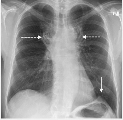 Continuous Diaphragm Sign