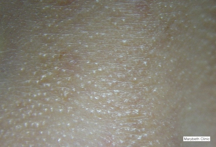 86. 미세면포 (微細面皰[ 面疱], Microcomedones)- 피부질환 백과사전﻿﻿ : 네이버 블로그