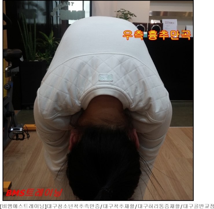 대구청소년척추측만증재활대구척추재활대구허리통증재활대구골반교정 청소년척추측만증의 증상과 재활운동 네이버 블로그