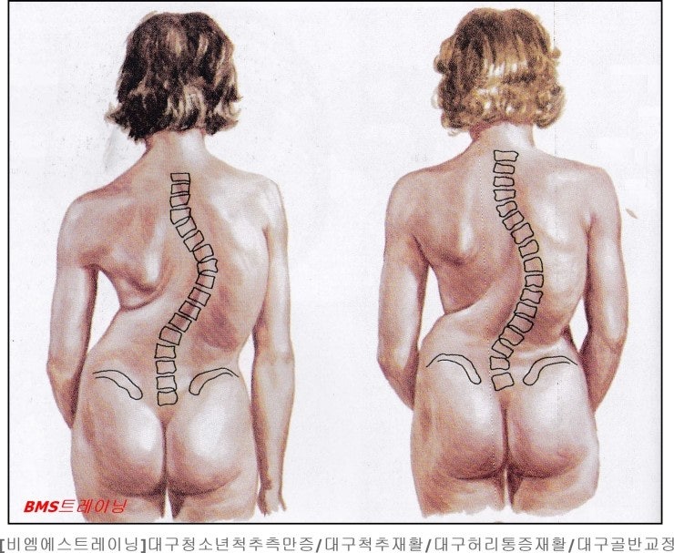 대구청소년척추측만증재활대구척추재활대구허리통증재활대구골반교정 청소년척추측만증의 증상과 재활운동 네이버 블로그