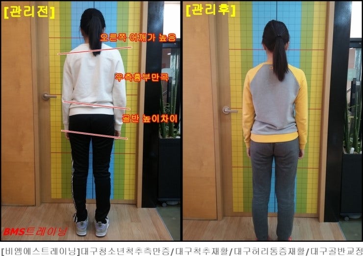 대구청소년척추측만증재활대구척추재활대구허리통증재활대구골반교정 청소년척추측만증의 증상과 재활운동 네이버 블로그