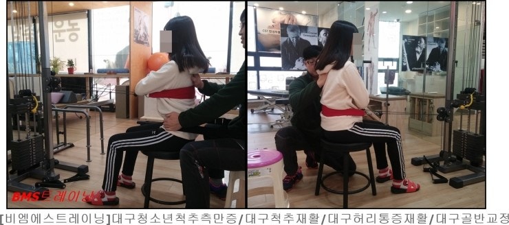 대구청소년척추측만증재활대구척추재활대구허리통증재활대구골반교정 청소년척추측만증의 증상과 재활운동 네이버 블로그