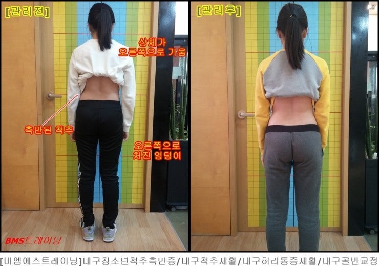 대구청소년척추측만증재활대구척추재활대구허리통증재활대구골반교정 청소년척추측만증의 증상과 재활운동 네이버 블로그