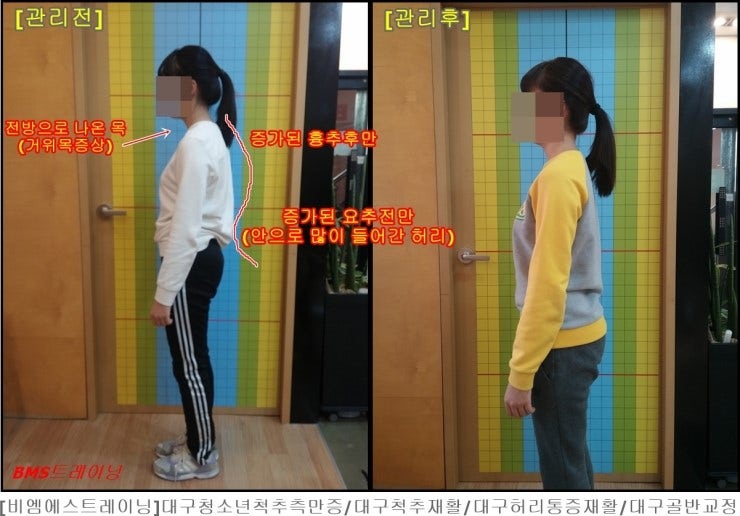대구청소년척추측만증재활대구척추재활대구허리통증재활대구골반교정 청소년척추측만증의 증상과 재활운동 네이버 블로그