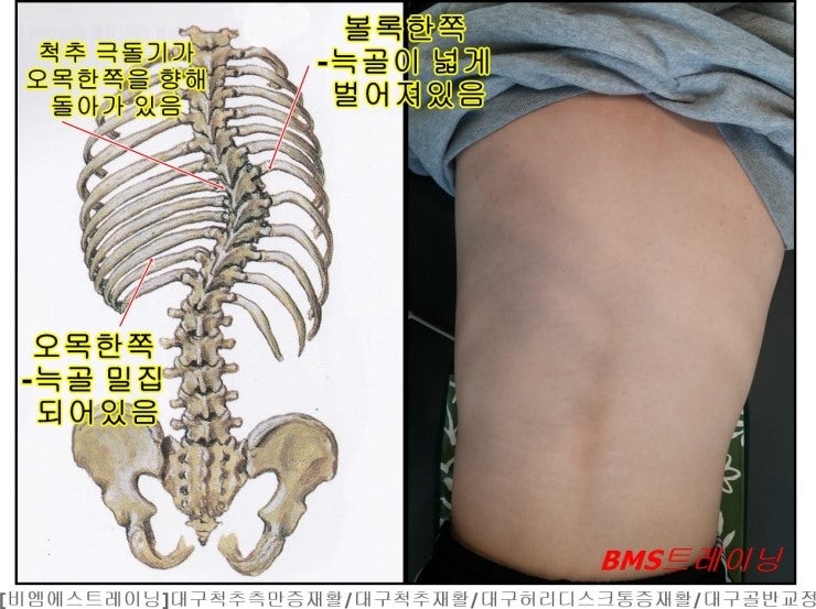 대구척추측만증재활대구척추재활대구허리디스크통증재활대구골반교정 허리통증과 척추측만증 증상과 재활운동 네이버 블로그