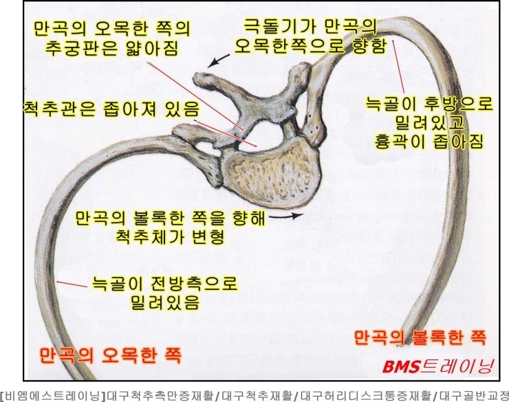 대구척추측만증재활대구척추재활대구허리디스크통증재활대구골반교정 허리통증과 척추측만증 증상과 재활운동 네이버 블로그