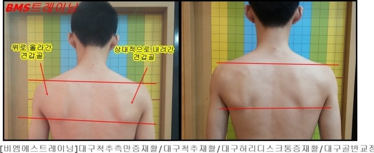 대구척추측만증재활대구척추재활대구허리디스크통증재활대구골반교정 허리통증과 척추측만증 증상과 재활운동 네이버 블로그