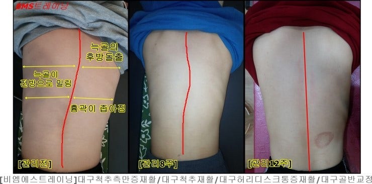 대구척추측만증재활대구척추재활대구허리디스크통증재활대구골반교정 허리통증과 척추측만증 증상과 재활운동 네이버 블로그