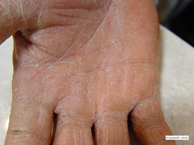 140. 손백선증 (수부백선, 手部白癬, Tinea manus) - 피부질환 백과사전﻿﻿ : 네이버 블로그