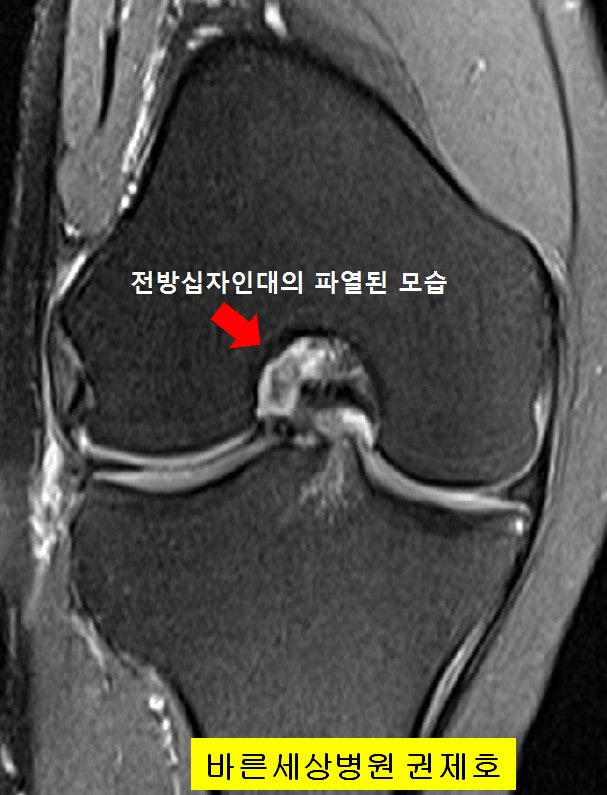 전방 십자인대 파열 회사에서 족구하는 중에 무릎에서 뚝 전방 십자인대 재건술 타가건 제이본정형외과 권제호 네이버 블로그