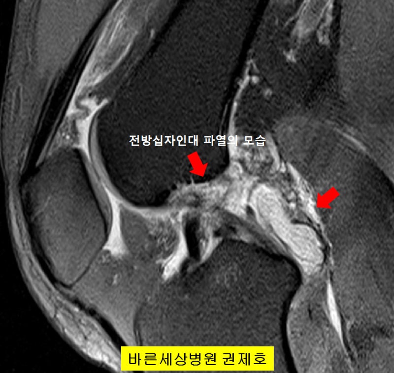 전방 십자인대 파열 회사에서 족구하는 중에 무릎에서 뚝 전방 십자인대 재건술 타가건 제이본정형외과 권제호 네이버 블로그