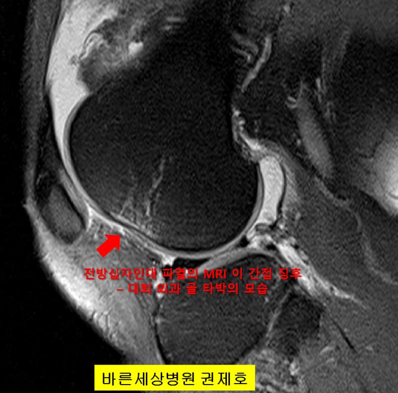 전방 십자인대 파열 회사에서 족구하는 중에 무릎에서 뚝 전방 십자인대 재건술 타가건 제이본정형외과 권제호 네이버 블로그