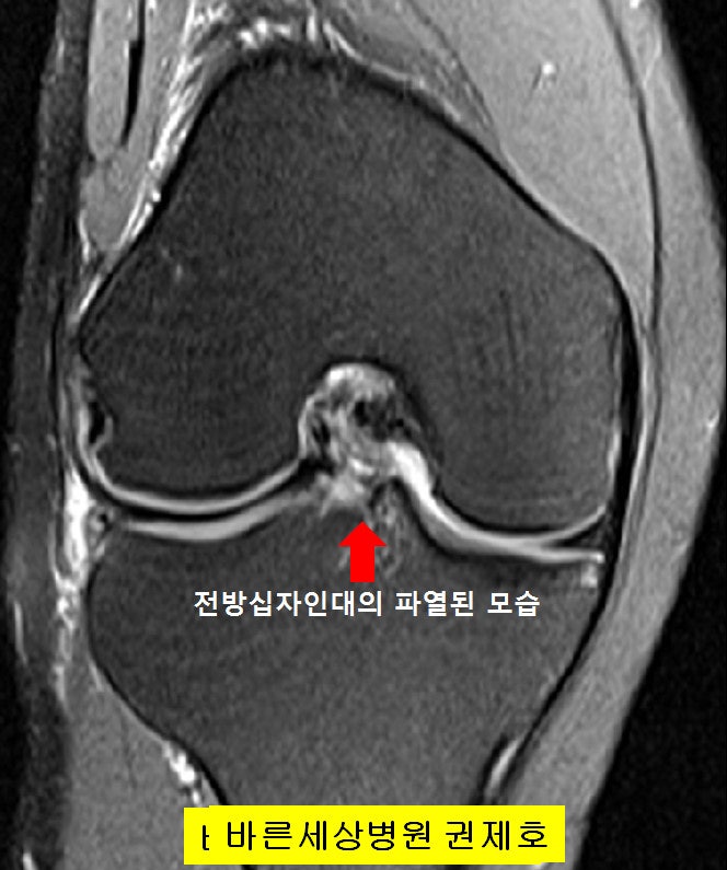 전방 십자인대 파열 회사에서 족구하는 중에 무릎에서 뚝 전방 십자인대 재건술 타가건 제이본정형외과 권제호 네이버 블로그