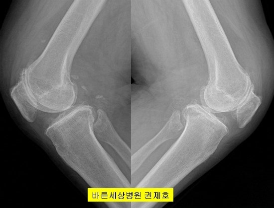 퇴행성관절염으로 아프면 인공관절수술 Feat 권제호무릎수술일지 네이버 블로그