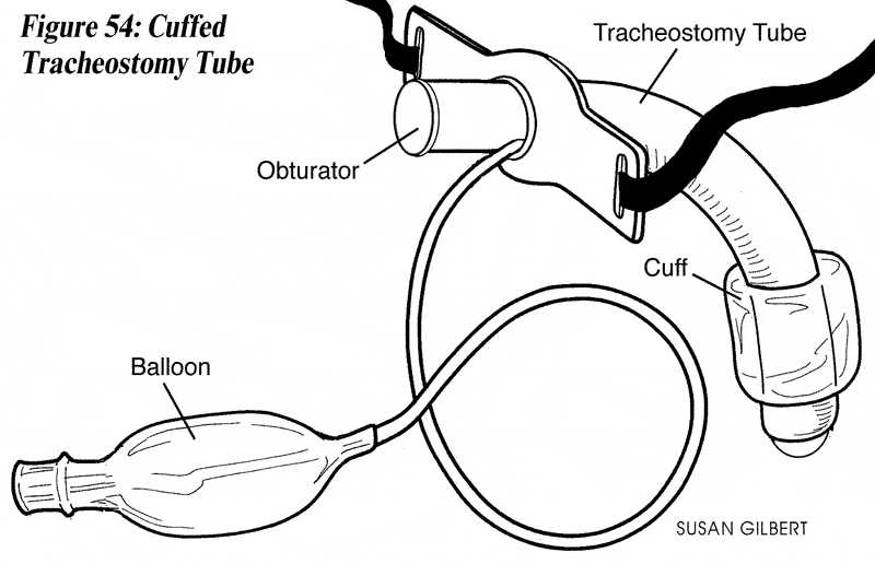 tracheostomy) 기관절개술 과정 및 정의 : 네이버 블로그
